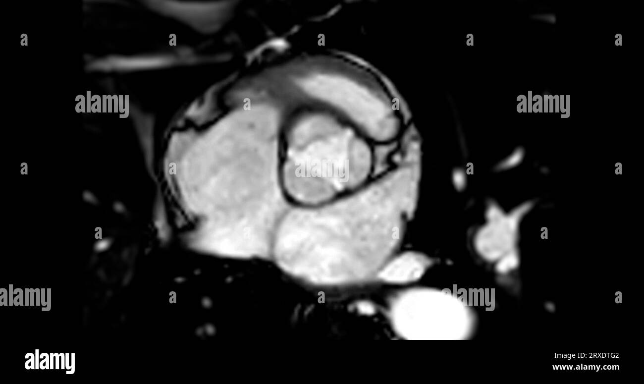 IRM cardiaque ou IRM cardiaque ( imagerie par résonance magnétique ) du ...