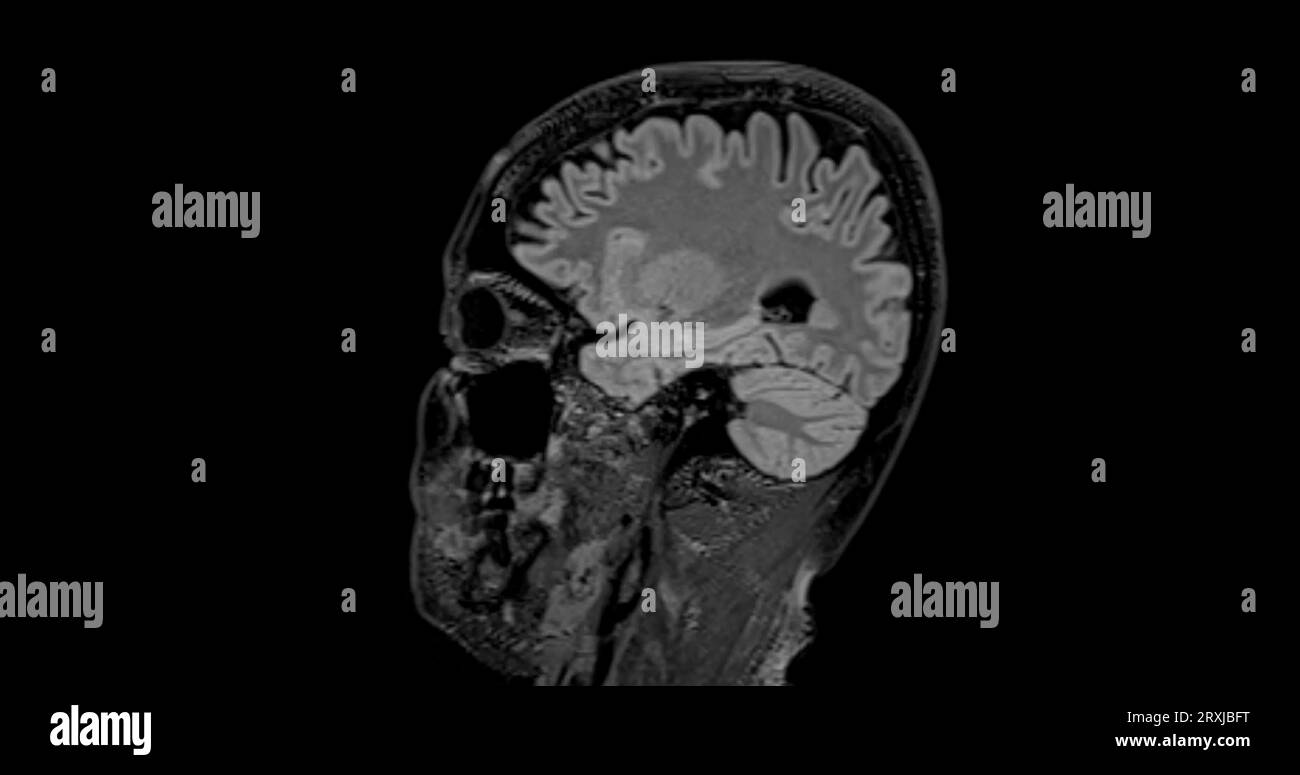 Flair sagittal d'IRM du cerveau pour détecter les maladies du cerveau ...