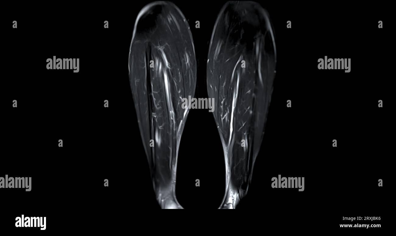 épanchement articulaire Banque de photographies et d’images à haute ...