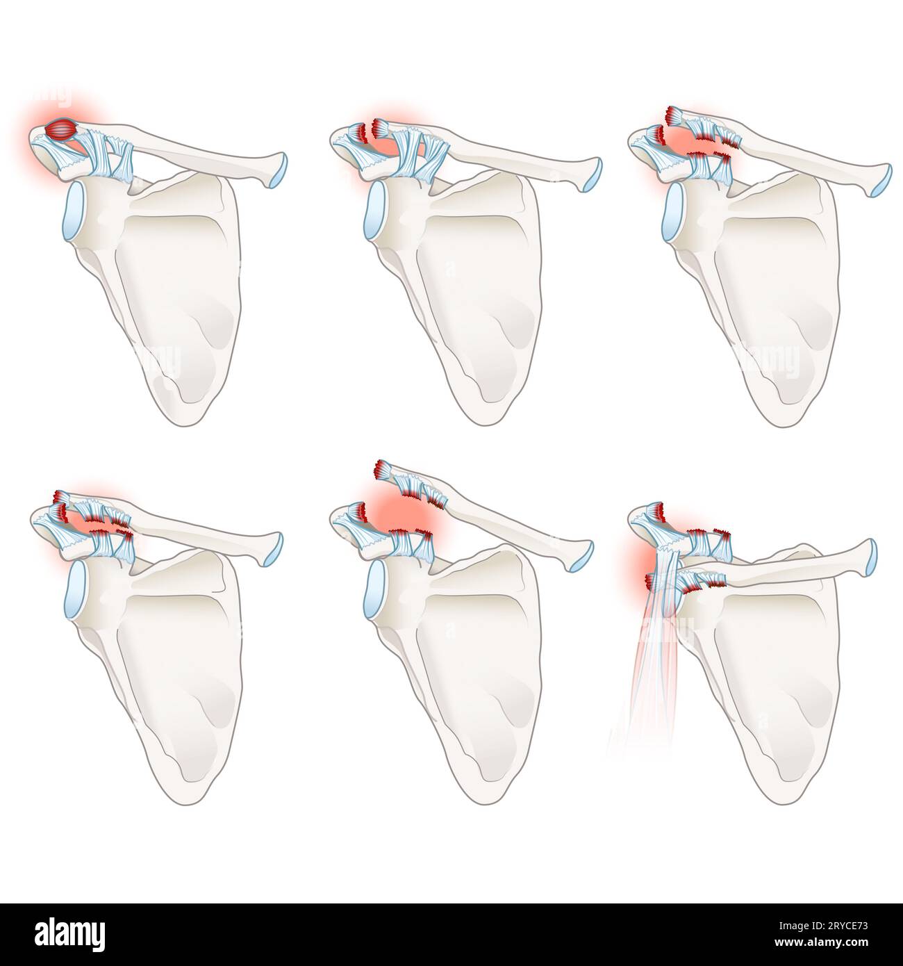 La séparation de l'articulation AC est une lésion de l'épaule ...
