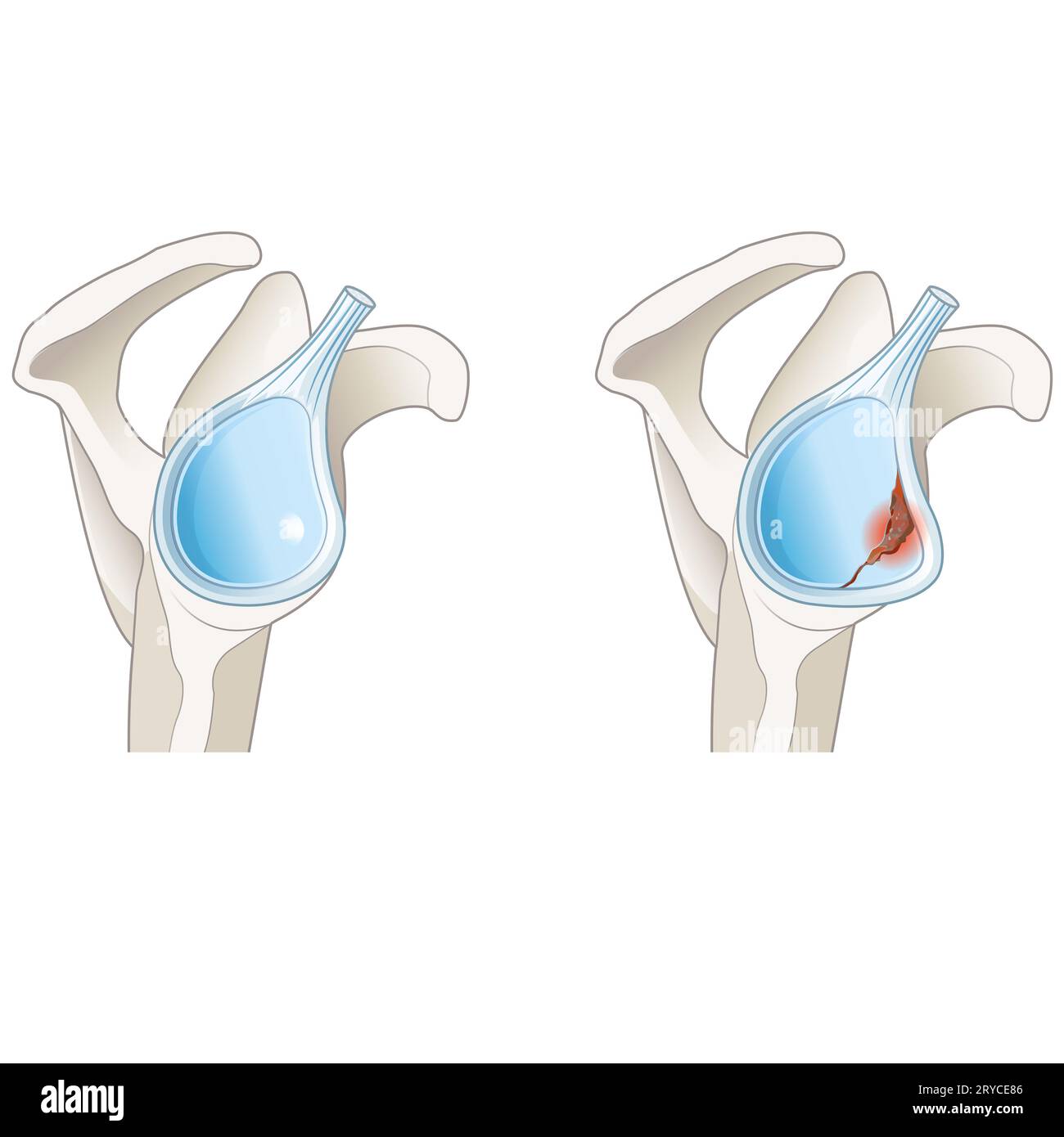 Une lésion osseuse de Bankart dans l'épaule implique une fracture du ...