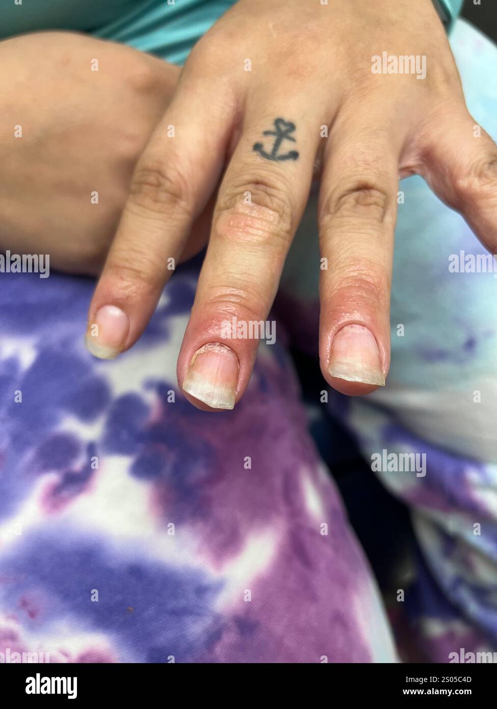 Psoriasis sur les doigts d'un patient. Le psoriasis est une affection ...