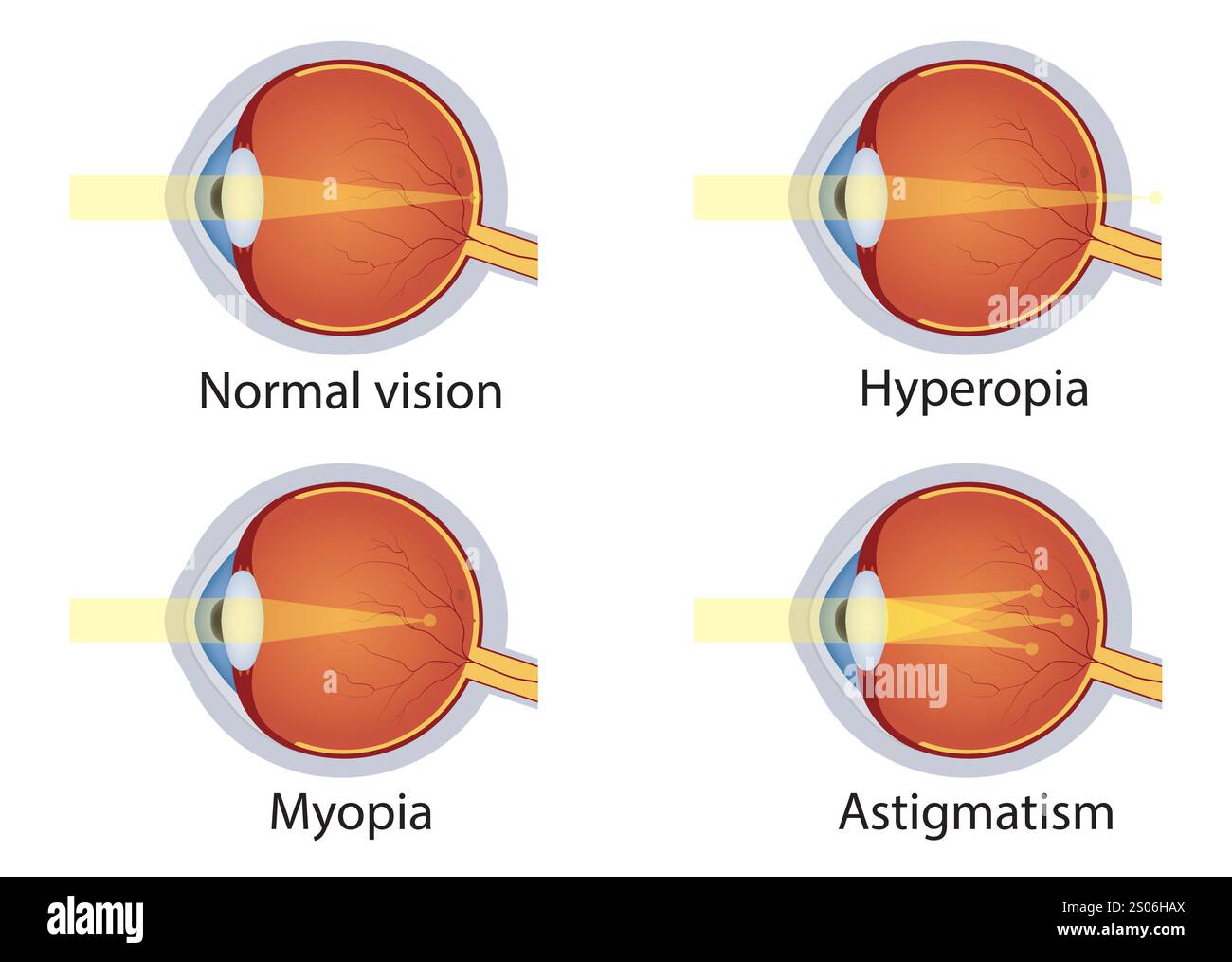Troubles de la vision. Concept de défaut oculaire. Vision normale ...