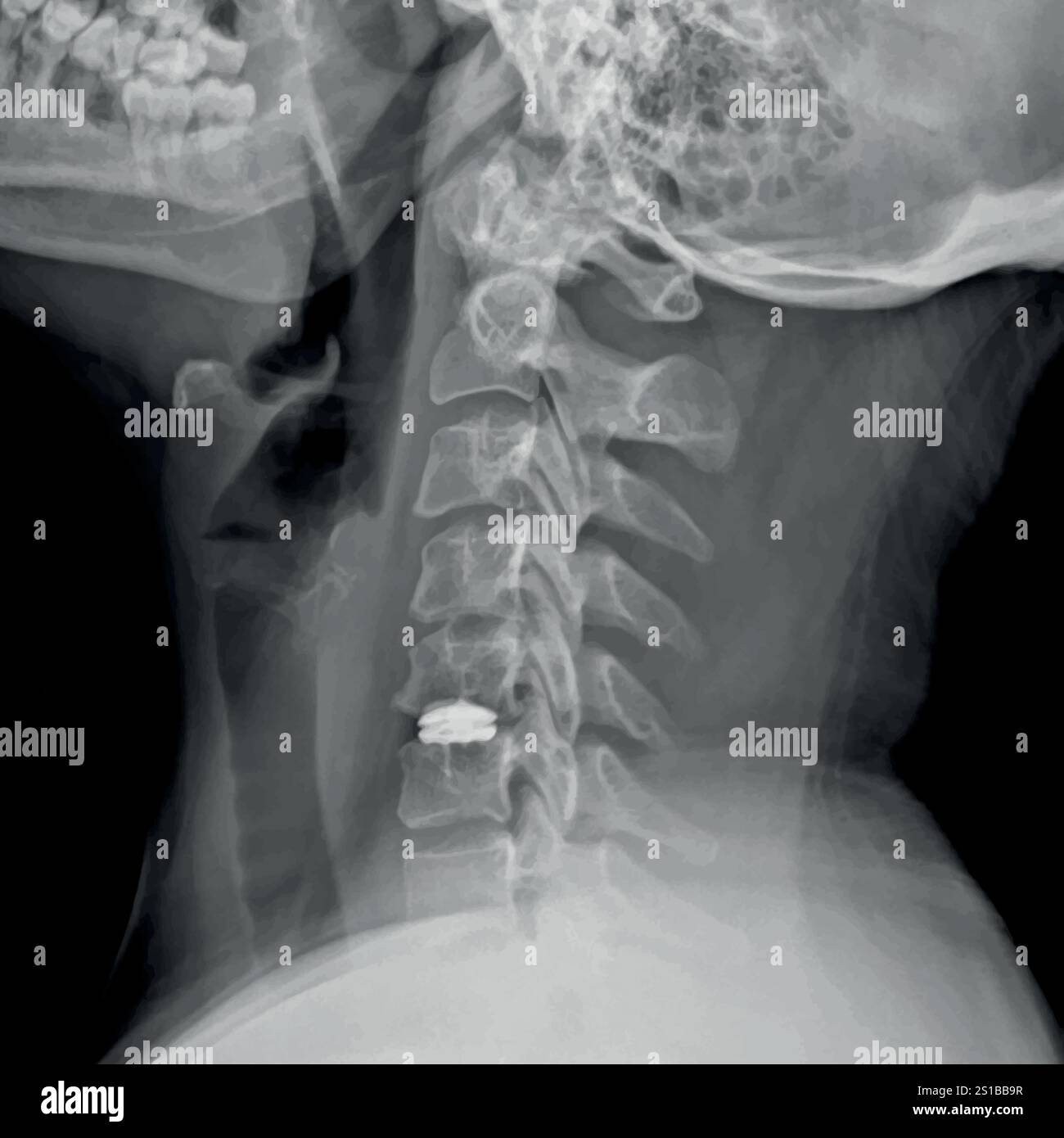 Radiographie cervicale d'un patient soumis à une microdiscectomie ...