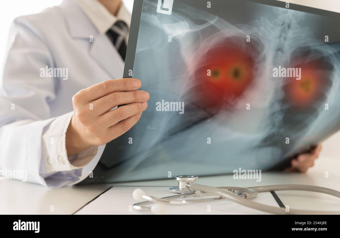 Cancer du poumon. Médecin radiologie vérifier l'image de radiographie ...