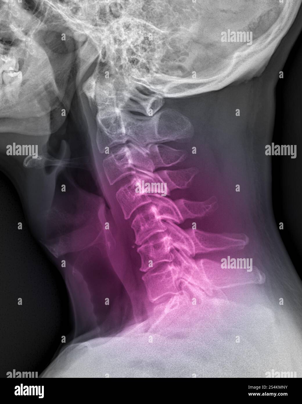 Radiographie du rachis cervical humain. Modification dégénérative ...