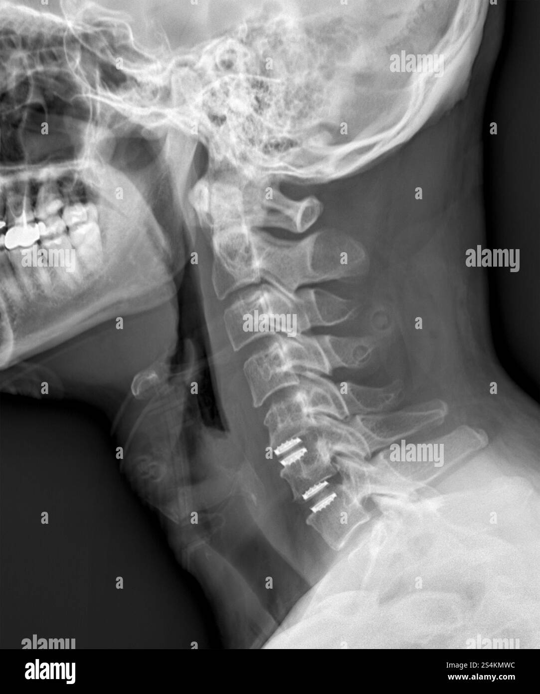 Hernie discale cervicale opération Banque d'images noir et blanc - Alamy