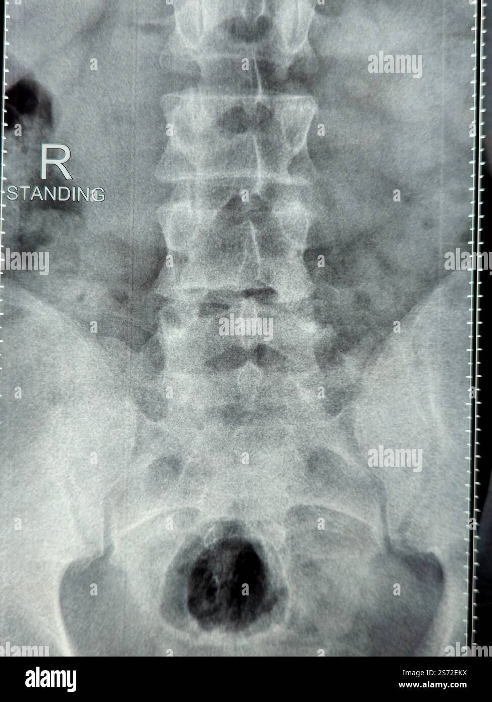 La radiographie du rachis lombo-sacré montre un redressement de la ...