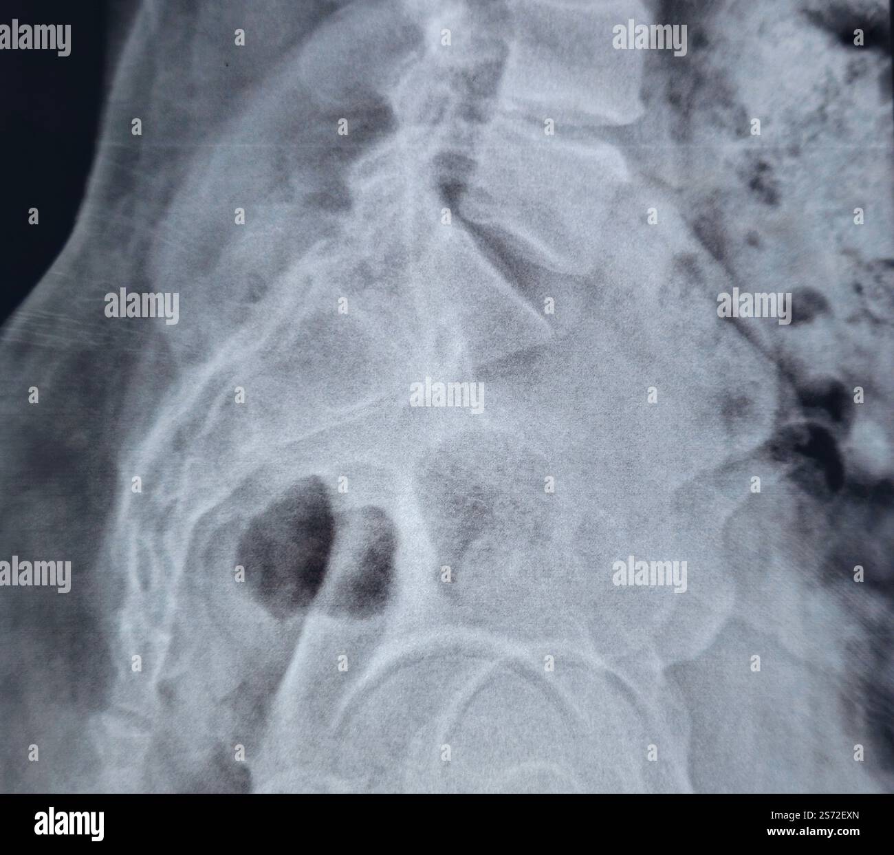 La radiographie du rachis lombo-sacré montre un redressement de la ...