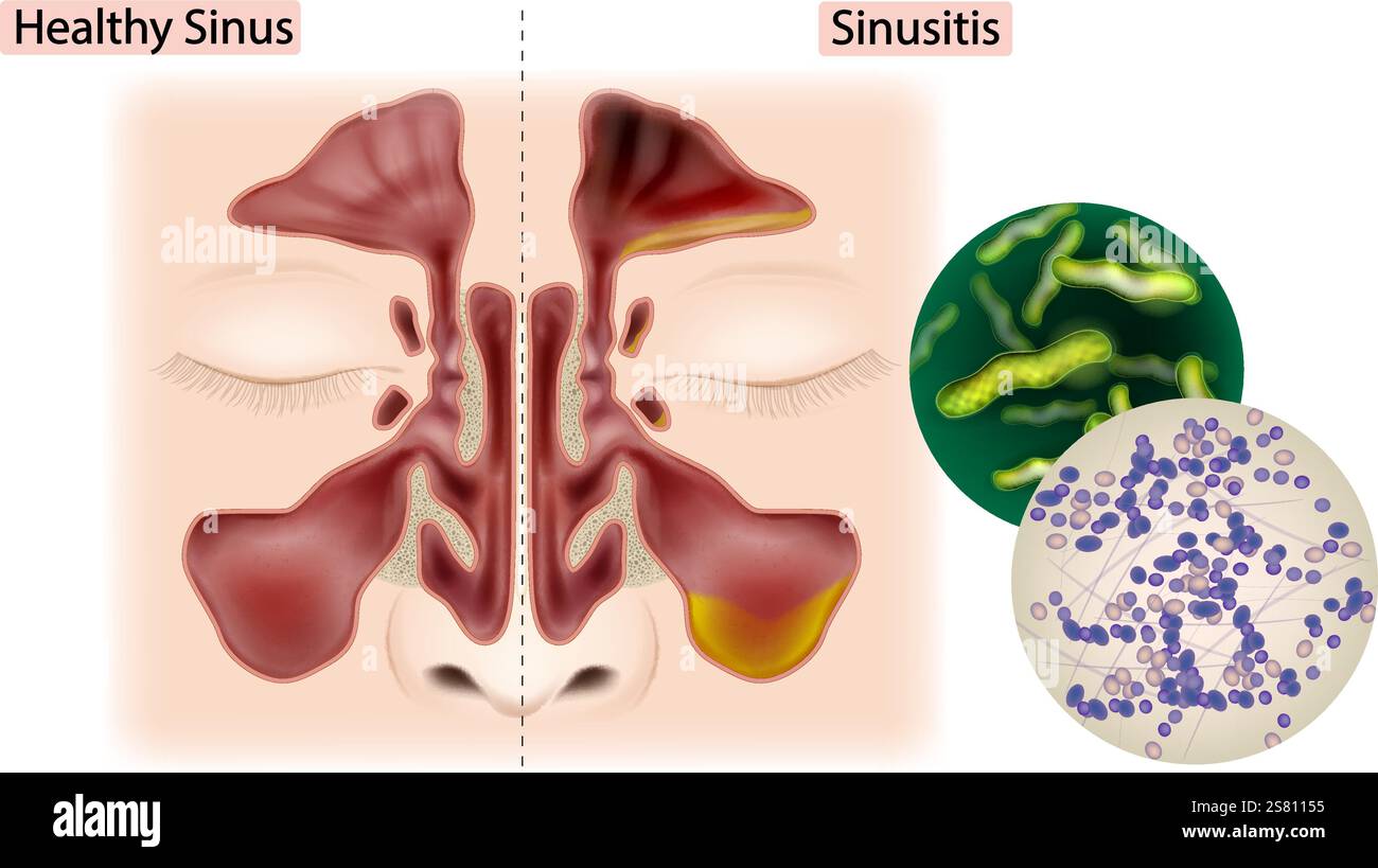 Sinus humains sains et infectés par sinusite. Illustration de l ...