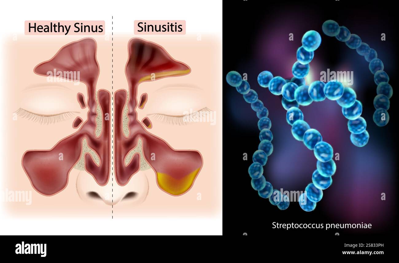Streptococcus pneumoniae schema Banque de photographies et d’images à ...