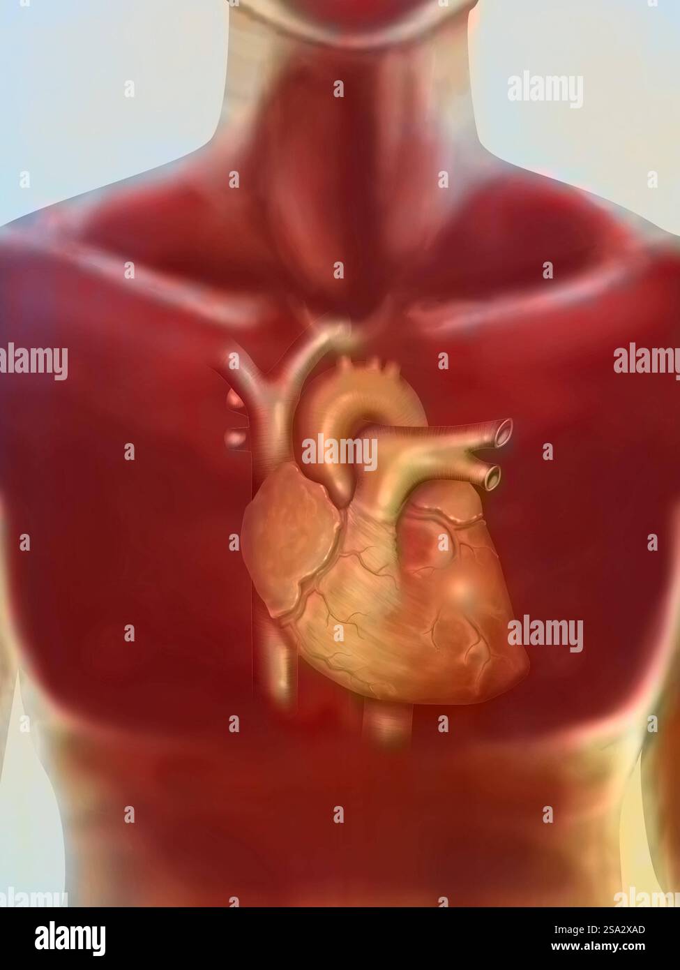 Infarctus du myocarde. Un infarctus du myocarde est une nécrose d'une ...