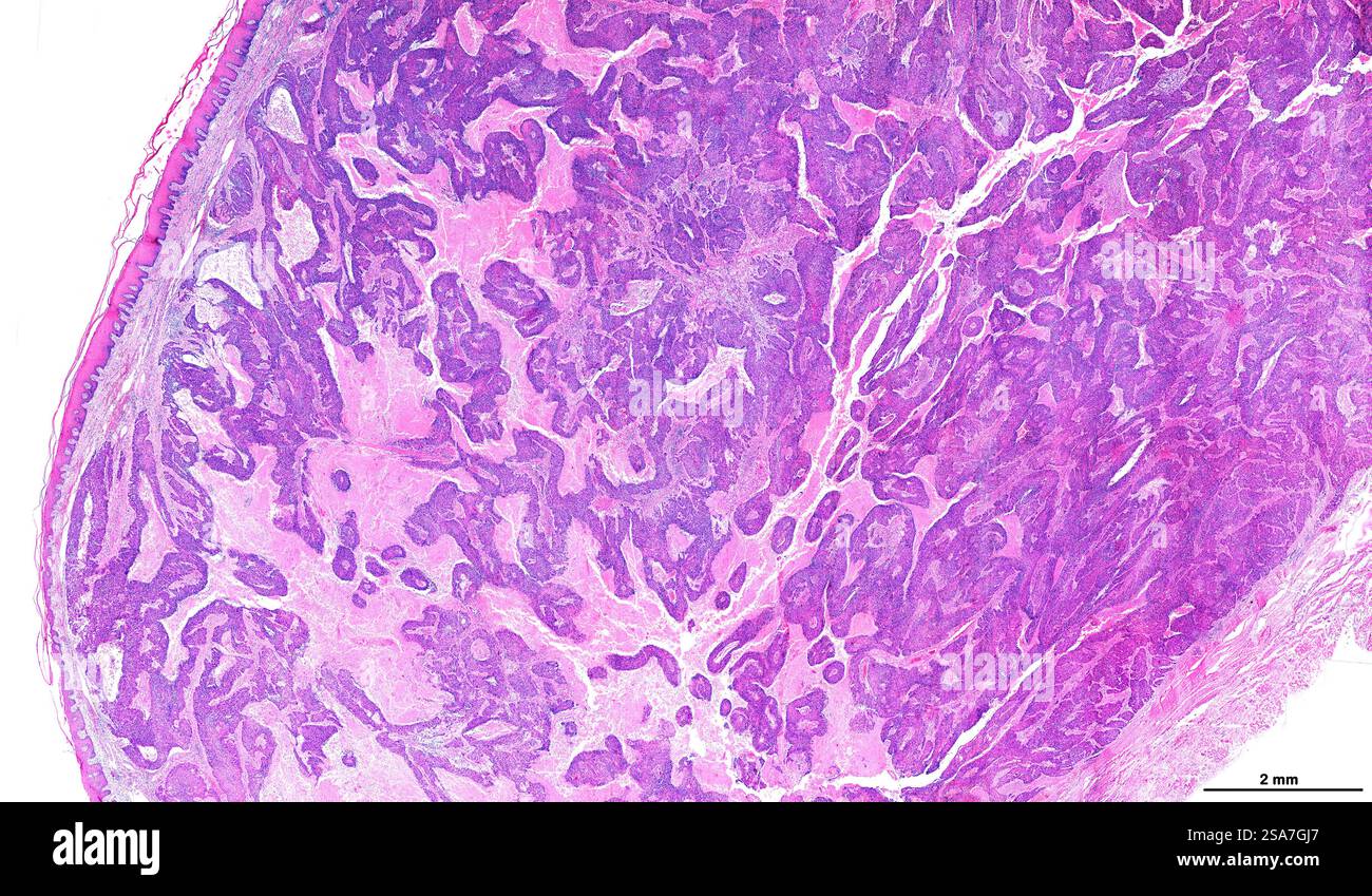 Micrographie à la lumière montrant un carcinome épidermoïde de grande taille, ou carcinome ...