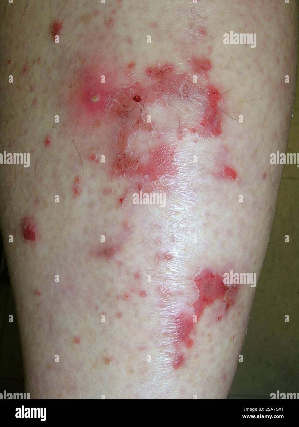 Lésions cutanées du pityriasis lichénoïde chronique. Cette condition ...