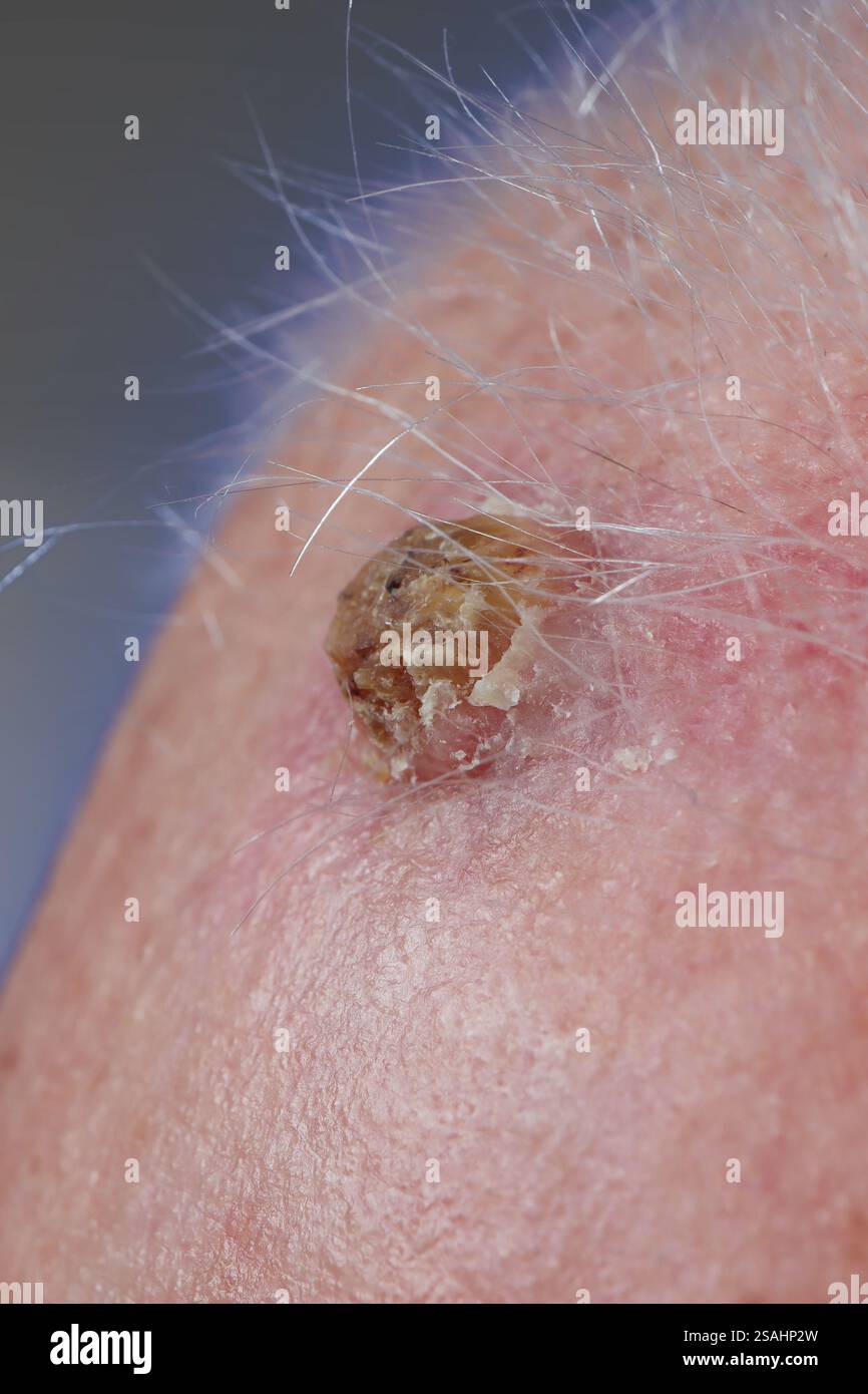 Carcinome épidermoïde du front chez un homme de 76 ans Photo Stock - Alamy