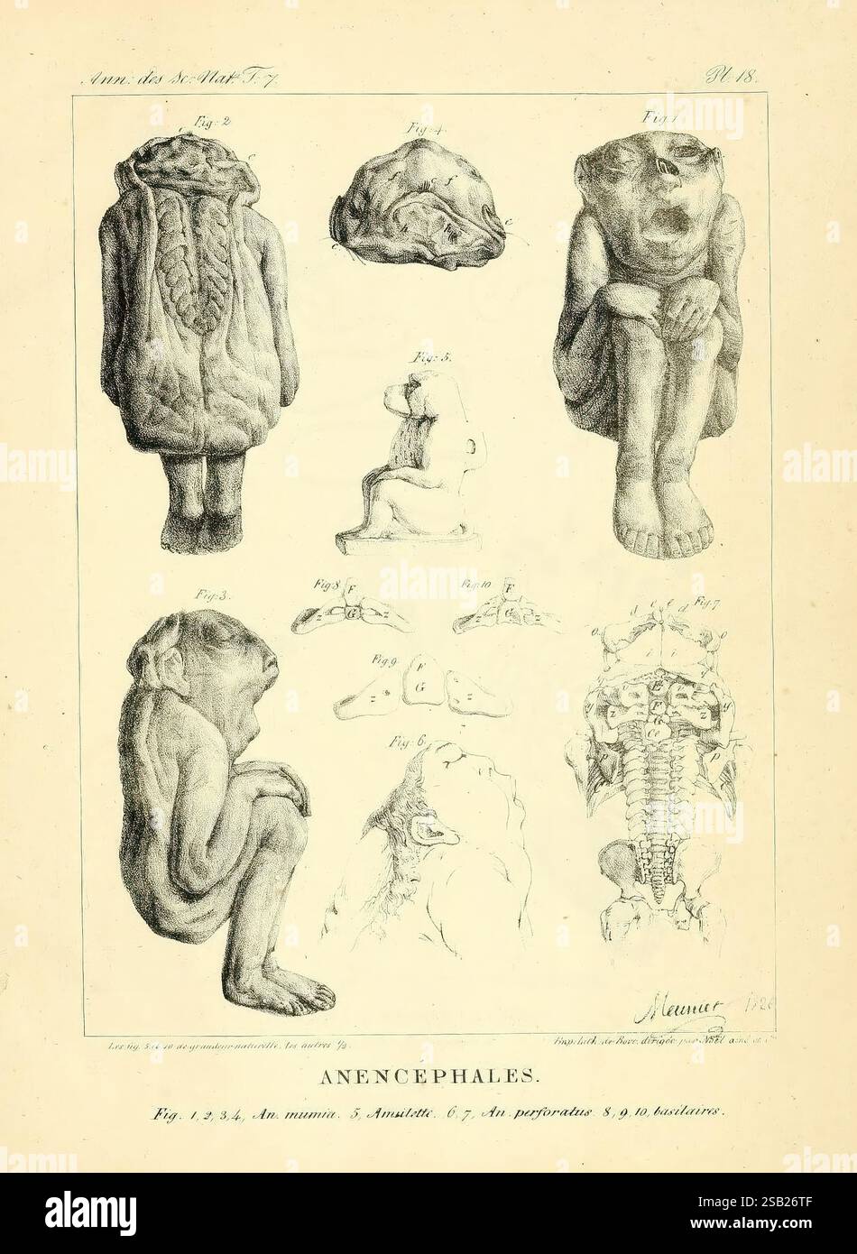 Annales des Sciences naturelles Paris Crochard anencéphalie Science ...