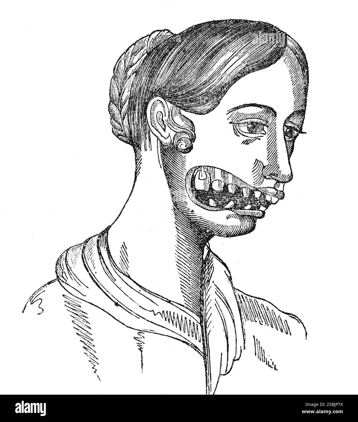 Phossy jaw Banque de photographies et d’images à haute résolution - Alamy