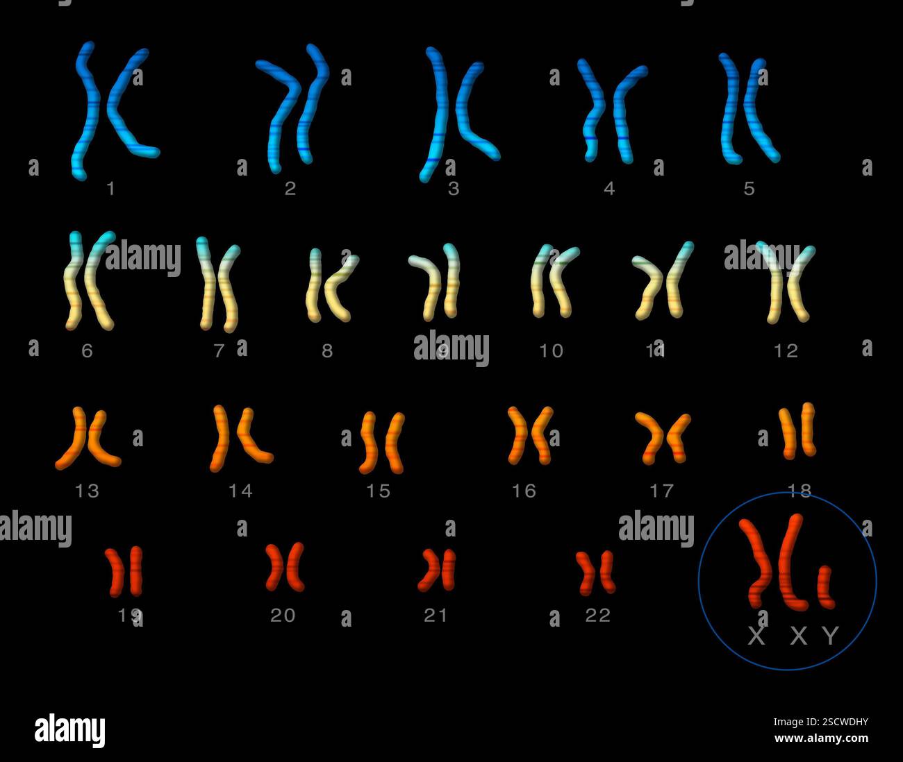 Illustration d'un caryotype montrant un syndrome de Klinefelter. Il s ...