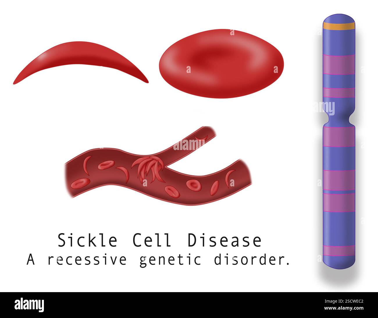 La drépanocytose est une maladie génétique récessive. Illustration ...