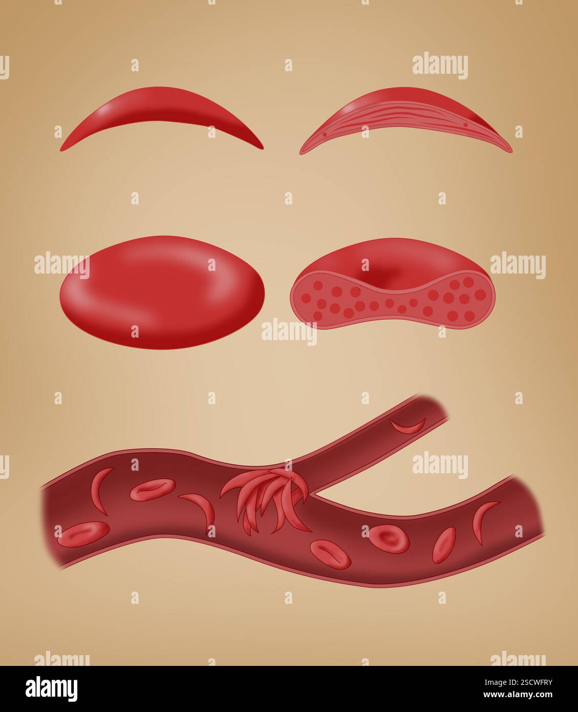 La drépanocytose est une maladie génétique récessive. Illustration ...