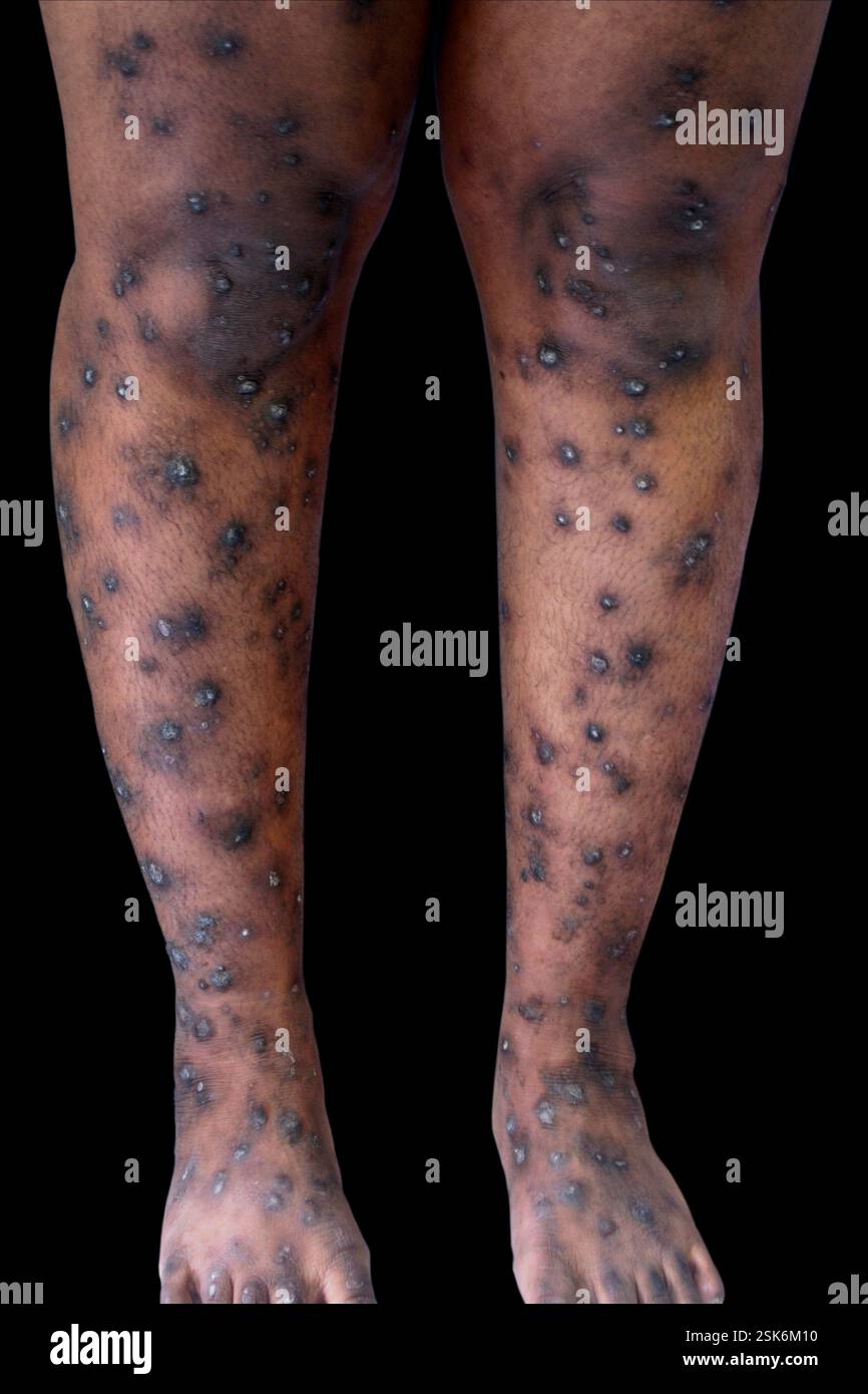 Lésions des jambes d'un homme de 32 ans avec prurigo. Le prurigo est ...