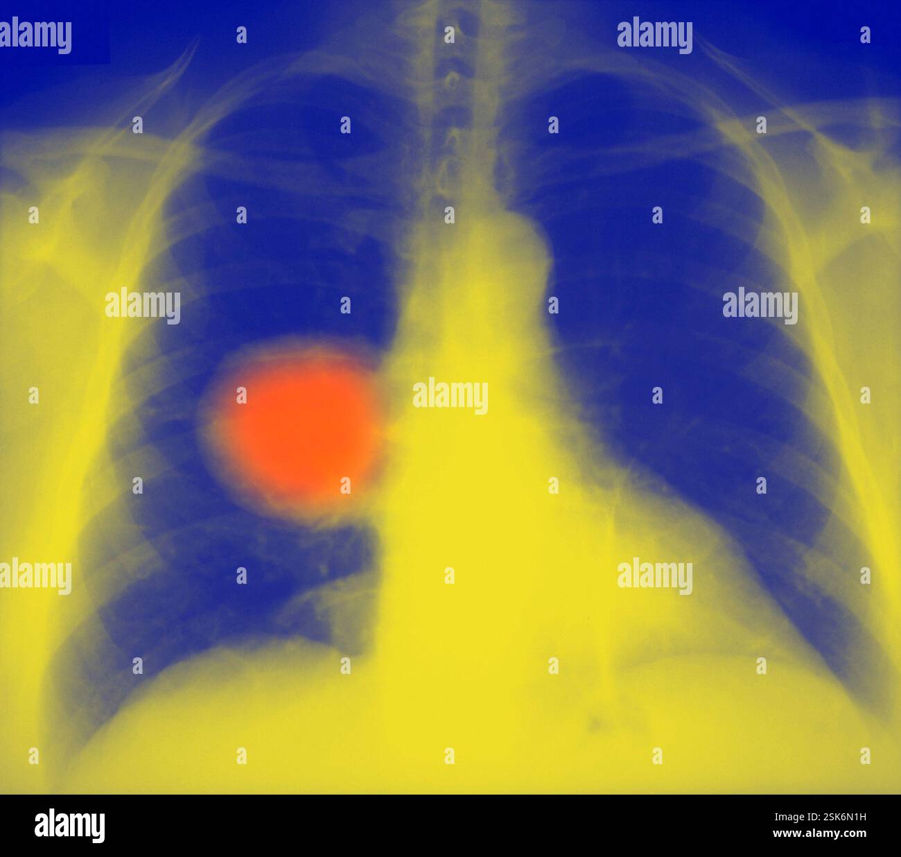 Cancer du poumon. Radiographie thoracique colorée montrant une tumeur ...