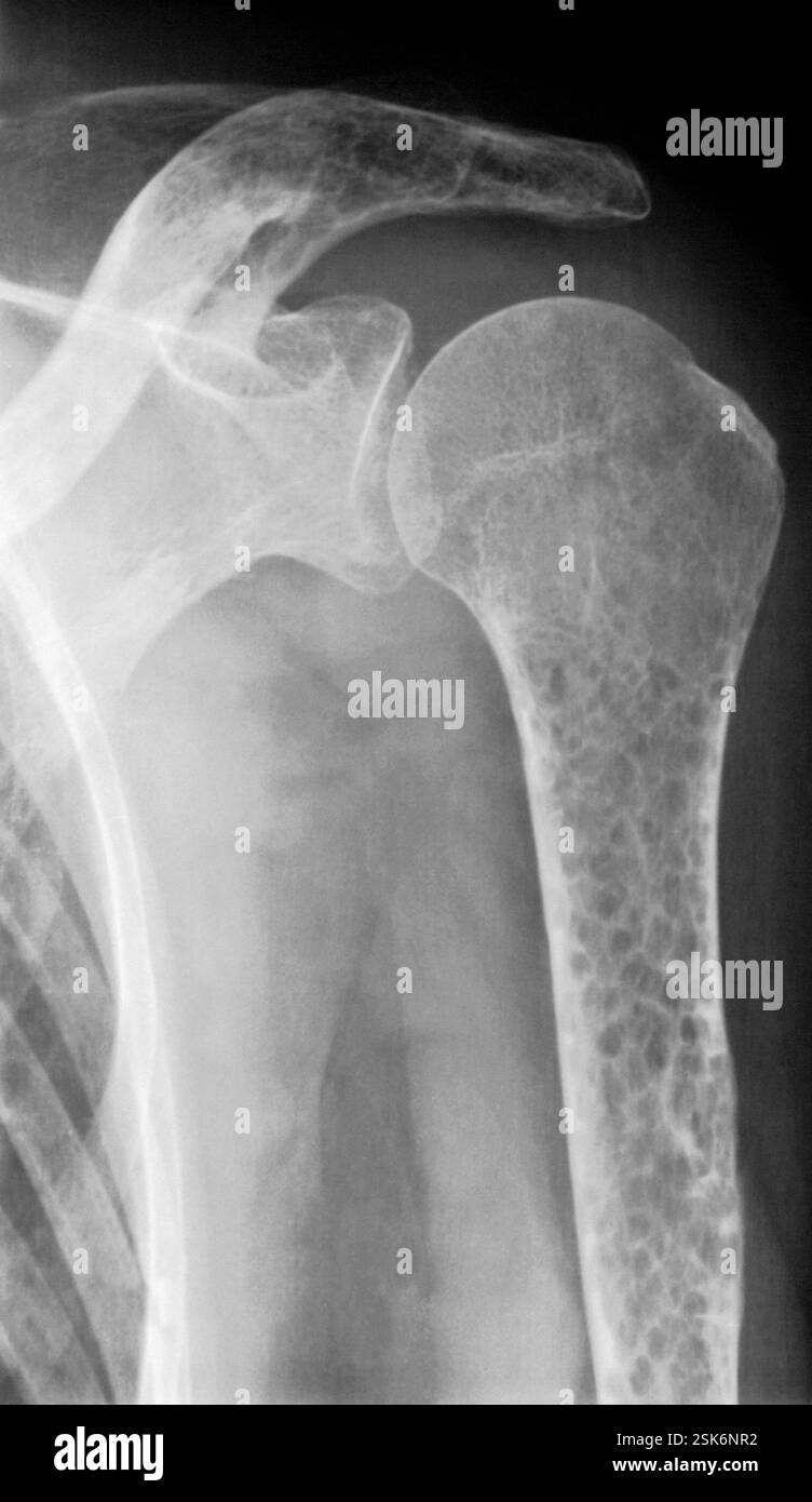 Cancer de la moelle osseuse. Radiographie frontale de l'épaule et du ...