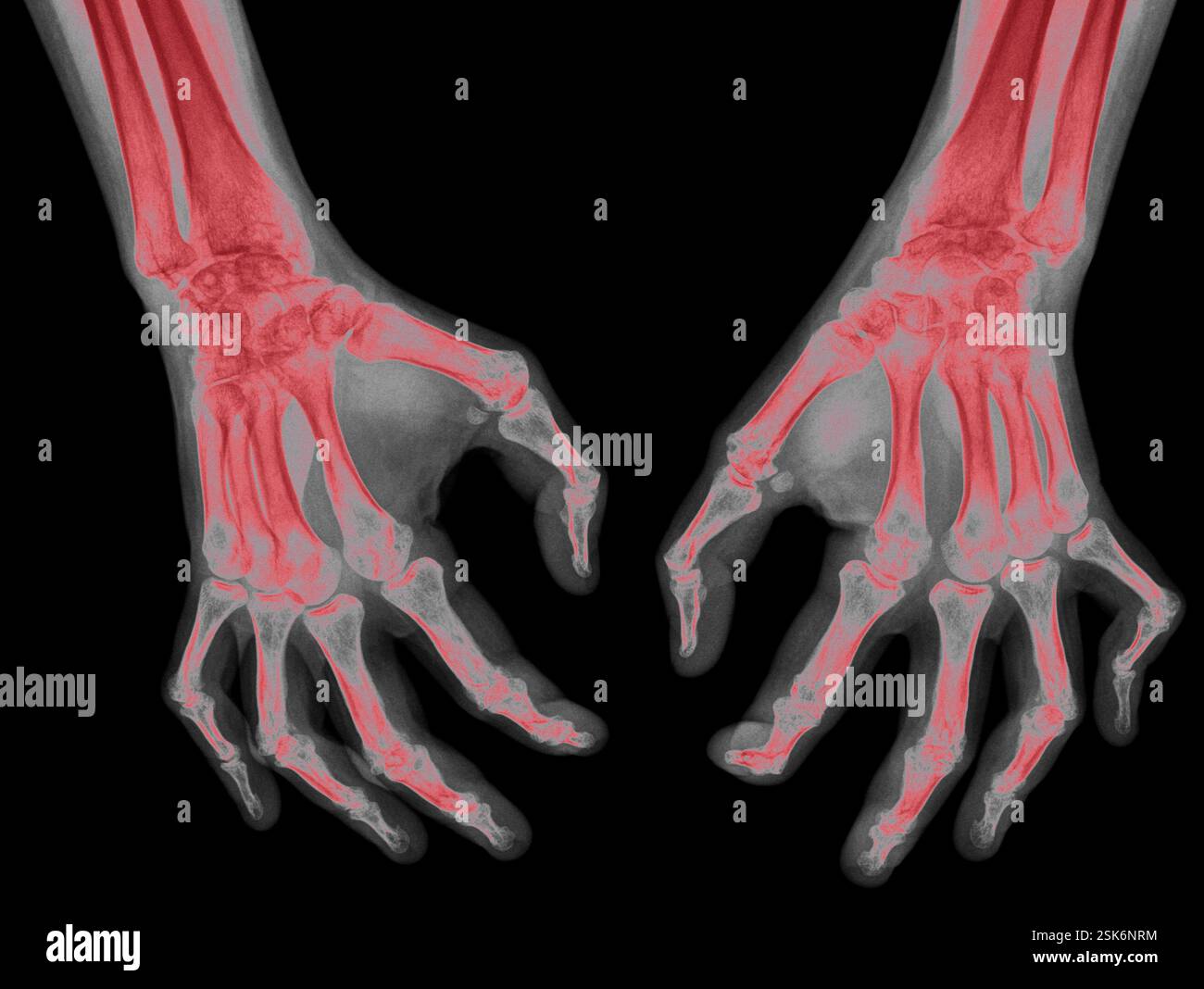 Radiographie colorée des mains d'un malade atteint de polyarthrite ...