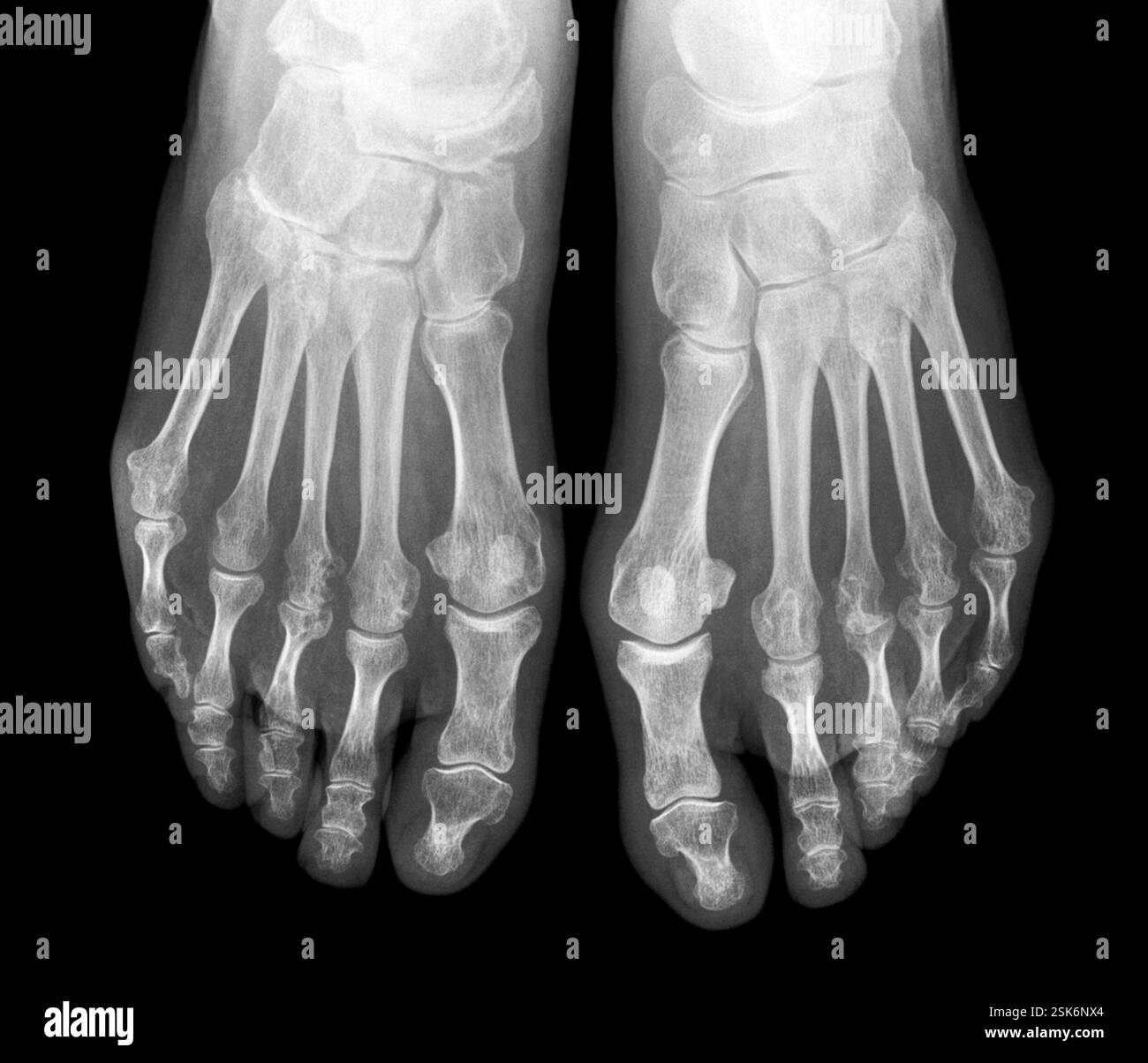 Radiographie des pieds d'un malade atteint de polyarthrite rhumatoïde ...