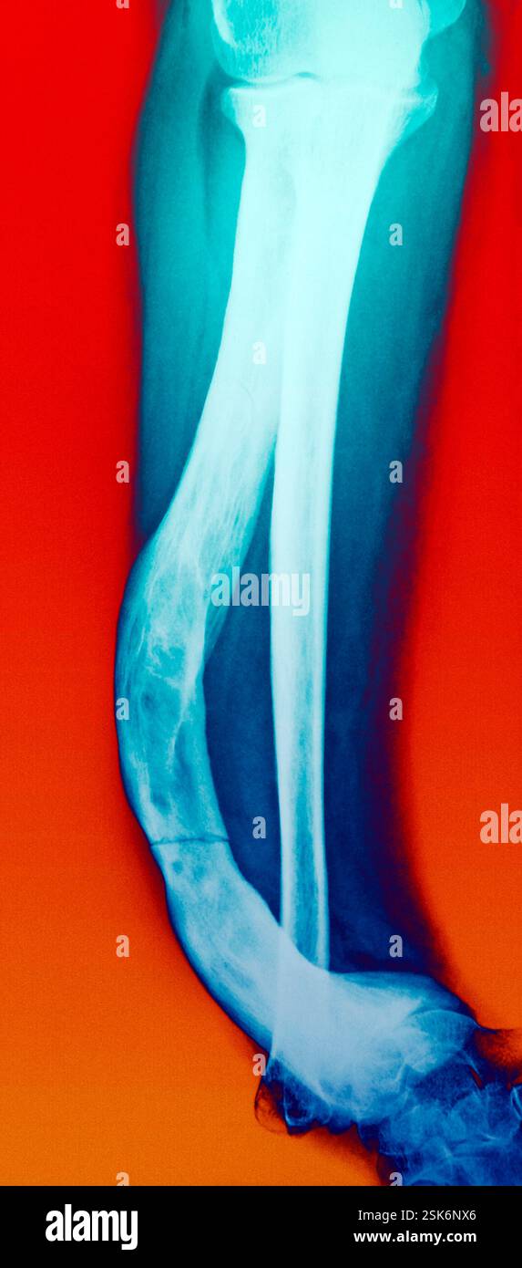 Maladie osseuse de Paget. Radiographie colorée de l'avant-bras d'un ...