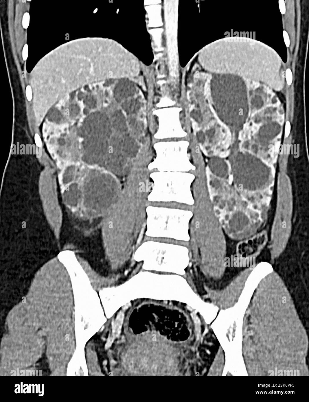 Les reins polykystiques. Tomodensitométrie (TDM) de l'abdomen d'une ...