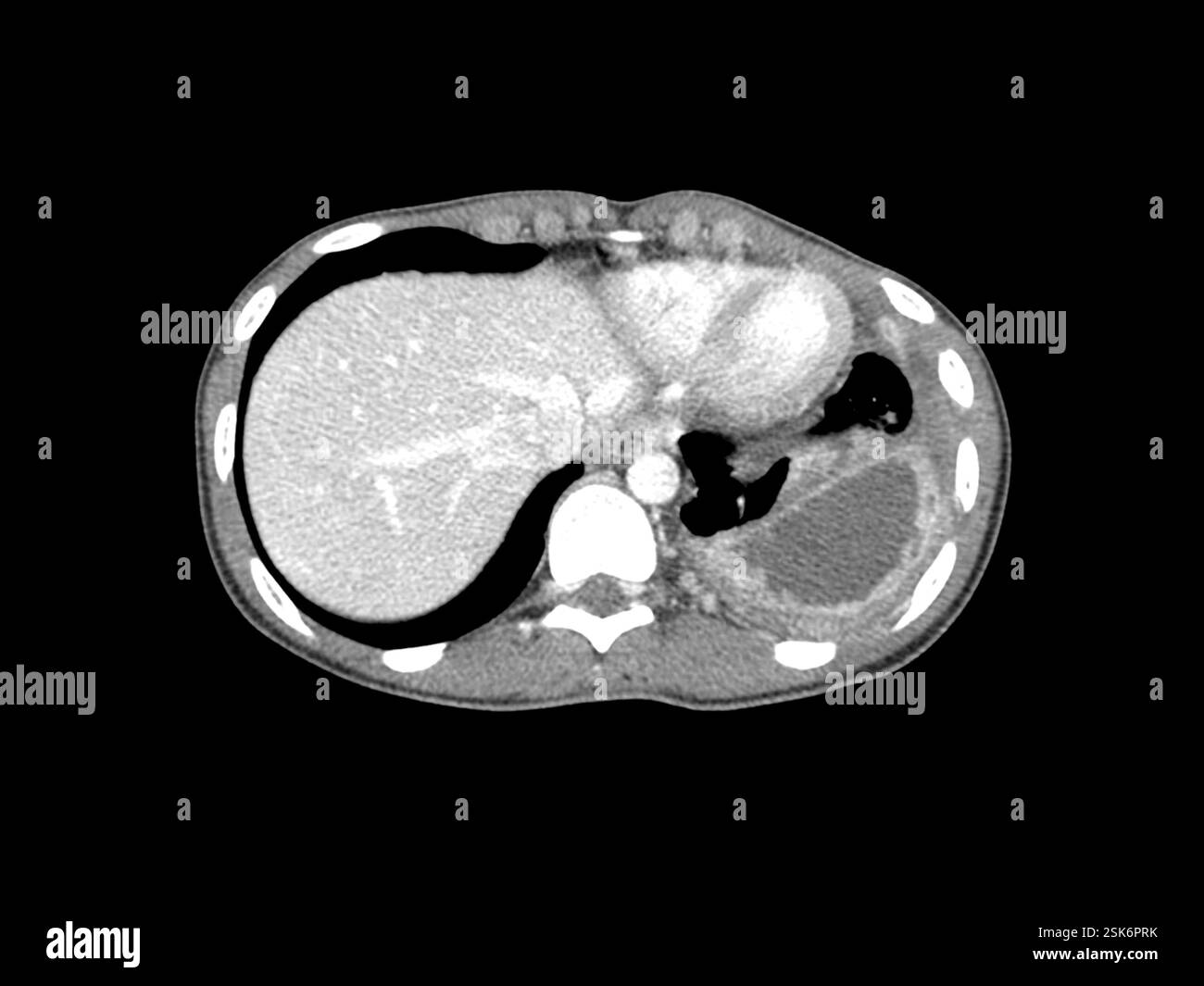 Tuberculose pleurale. Tomodensitométrie (TDM) d'une coupe axiale du ...