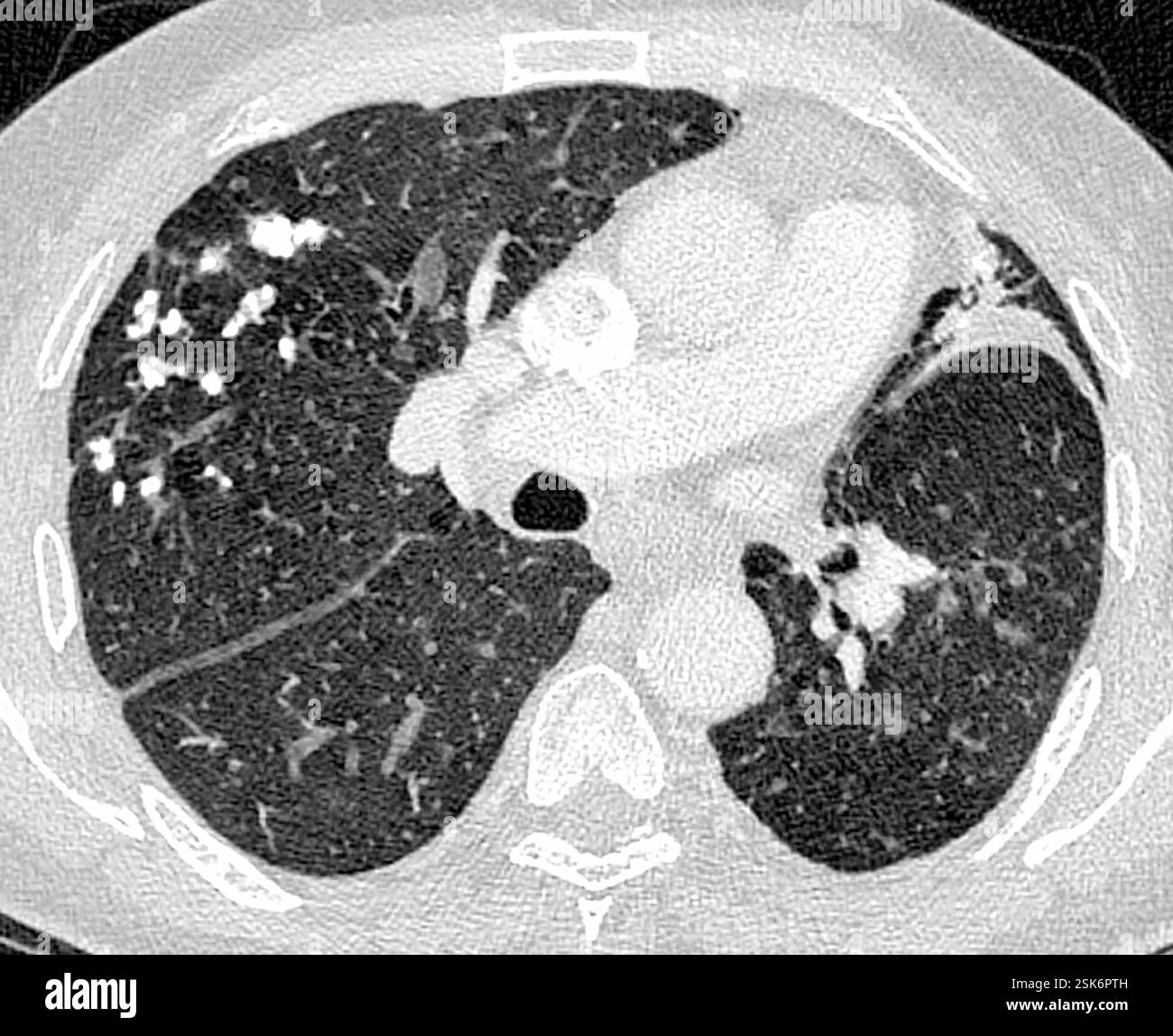Tuberculose du poumon. Tomodensitométrie (TDM) d'une coupe axiale du ...