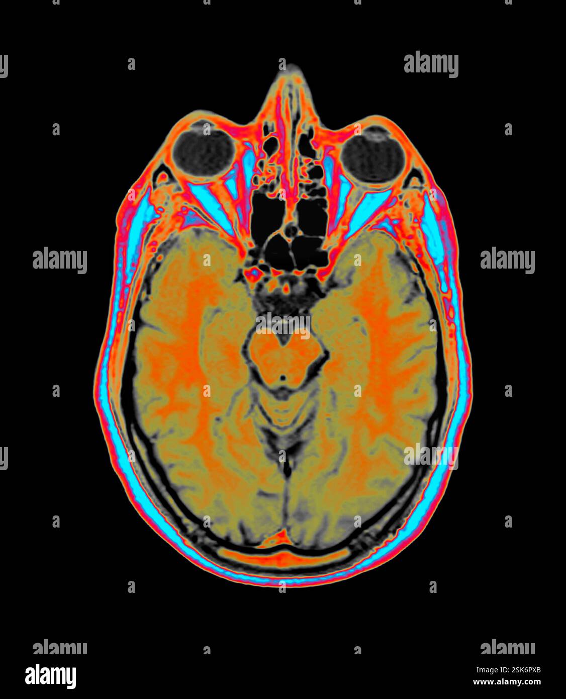 Cerveau normal. Imagerie par résonance magnétique (IRM) colorée d'une section de la tête ...