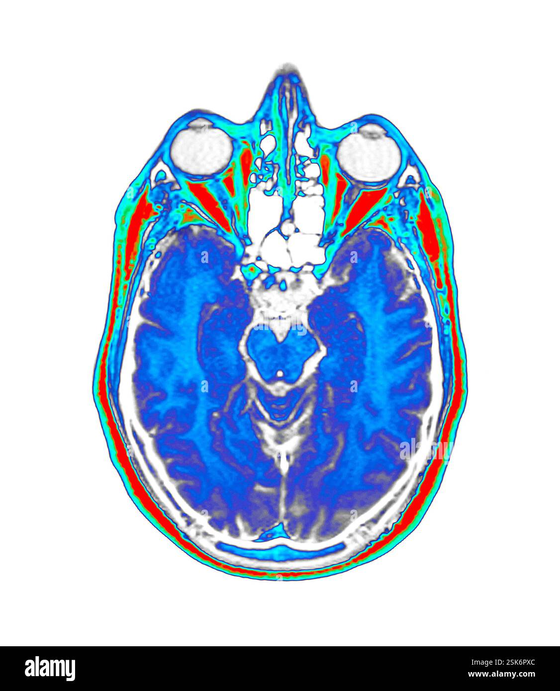Cerveau normal. Imagerie par résonance magnétique (IRM) colorée d'une section de la tête ...
