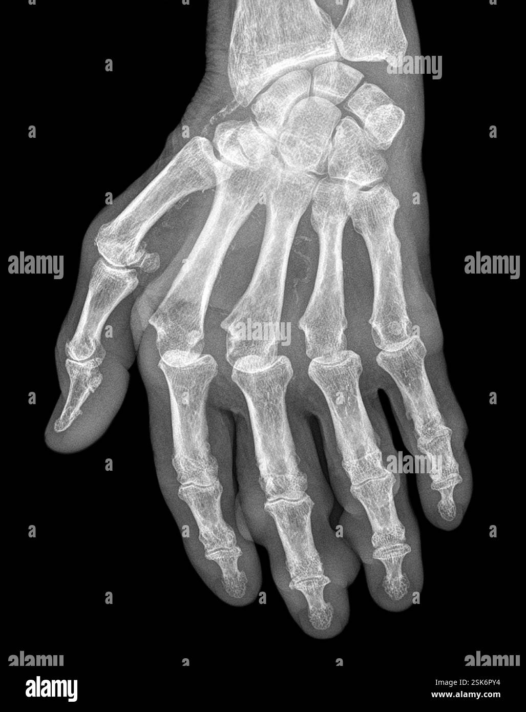 Main arthritique. Radiographie d'une section de la main gauche d'un ...
