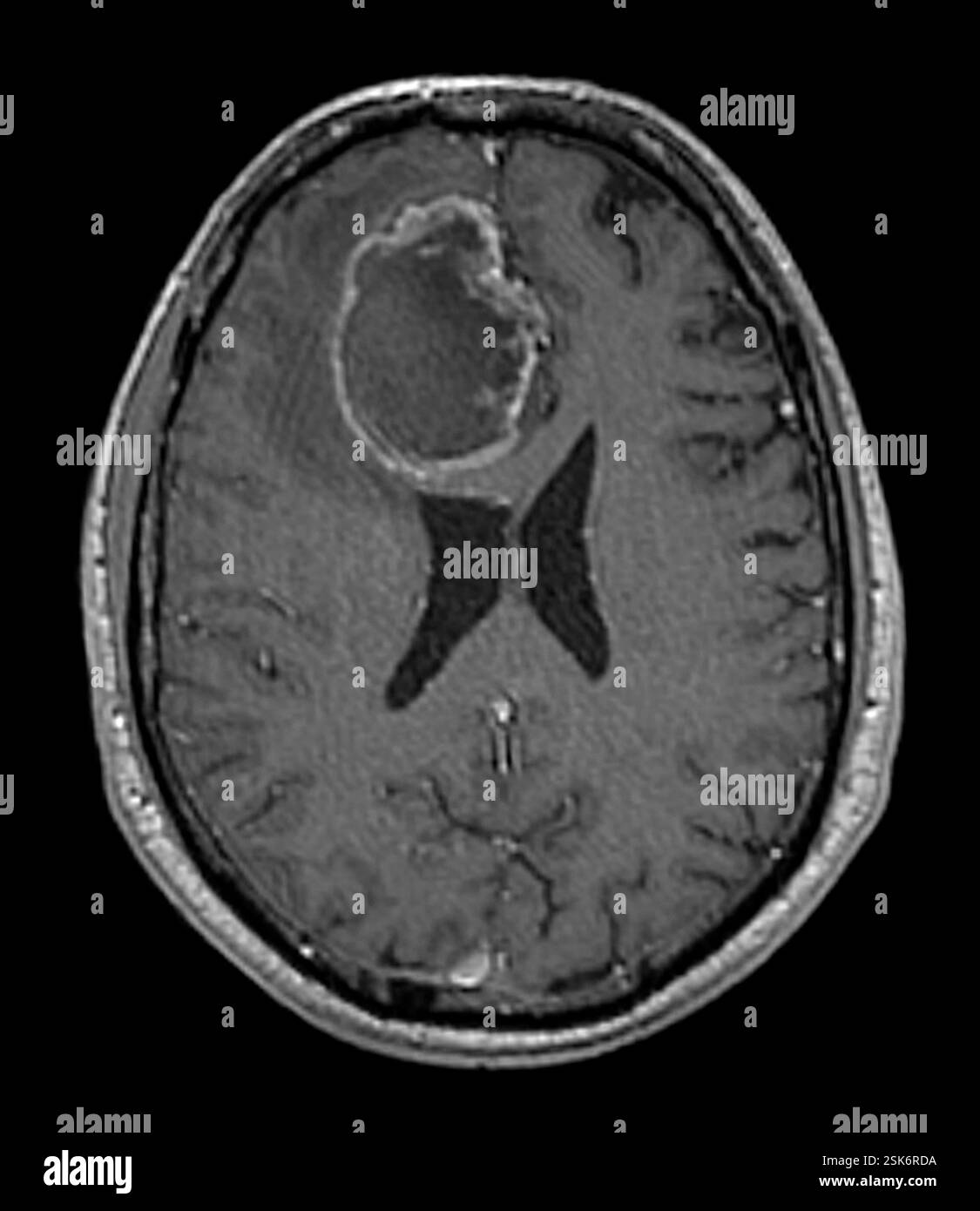Cancer du cerveau. Imagerie par résonance magnétique (IRM) pondérée en T1 d’une coupe axiale du ...