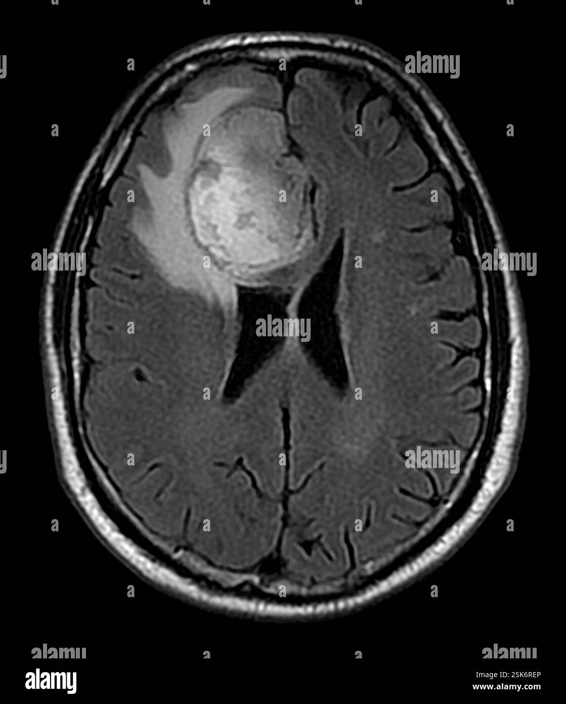 Cancer du cerveau. Imagerie par résonance magnétique (IRM) FLAIR (Fluid ...