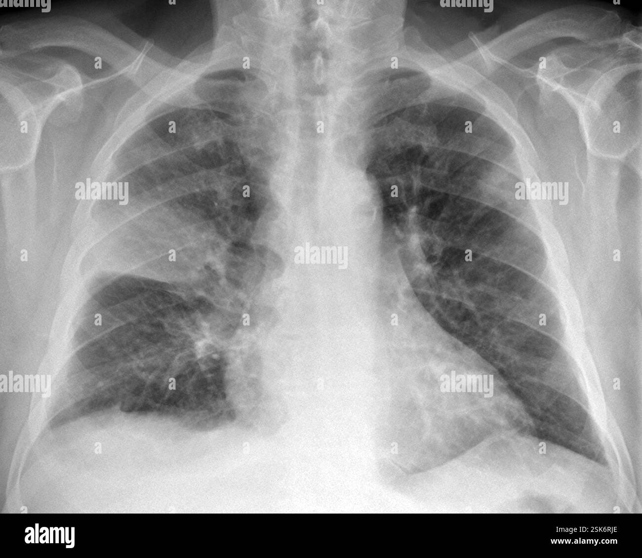 Pneumococcies. Radiographie frontale d'une section thoracique d'un ...