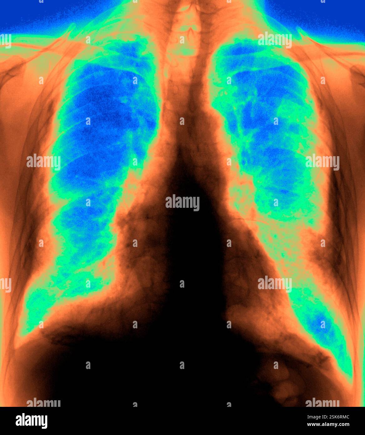 Asbestose pleurale. Radiographie thoracique frontale des poumons d'un ...