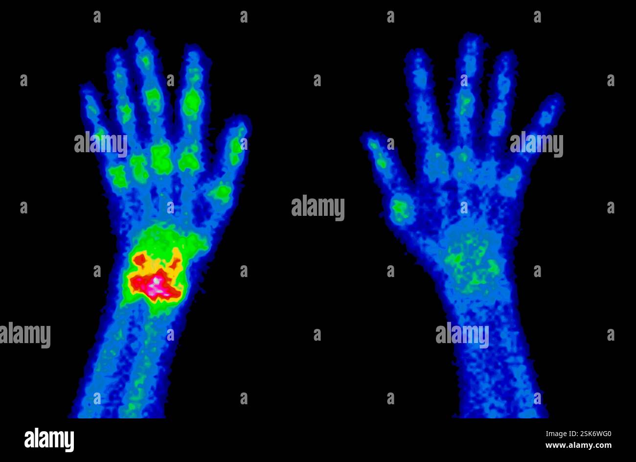 Algodystrophie des mains, scintigramme. L'algodystrophie (dystrophie ...