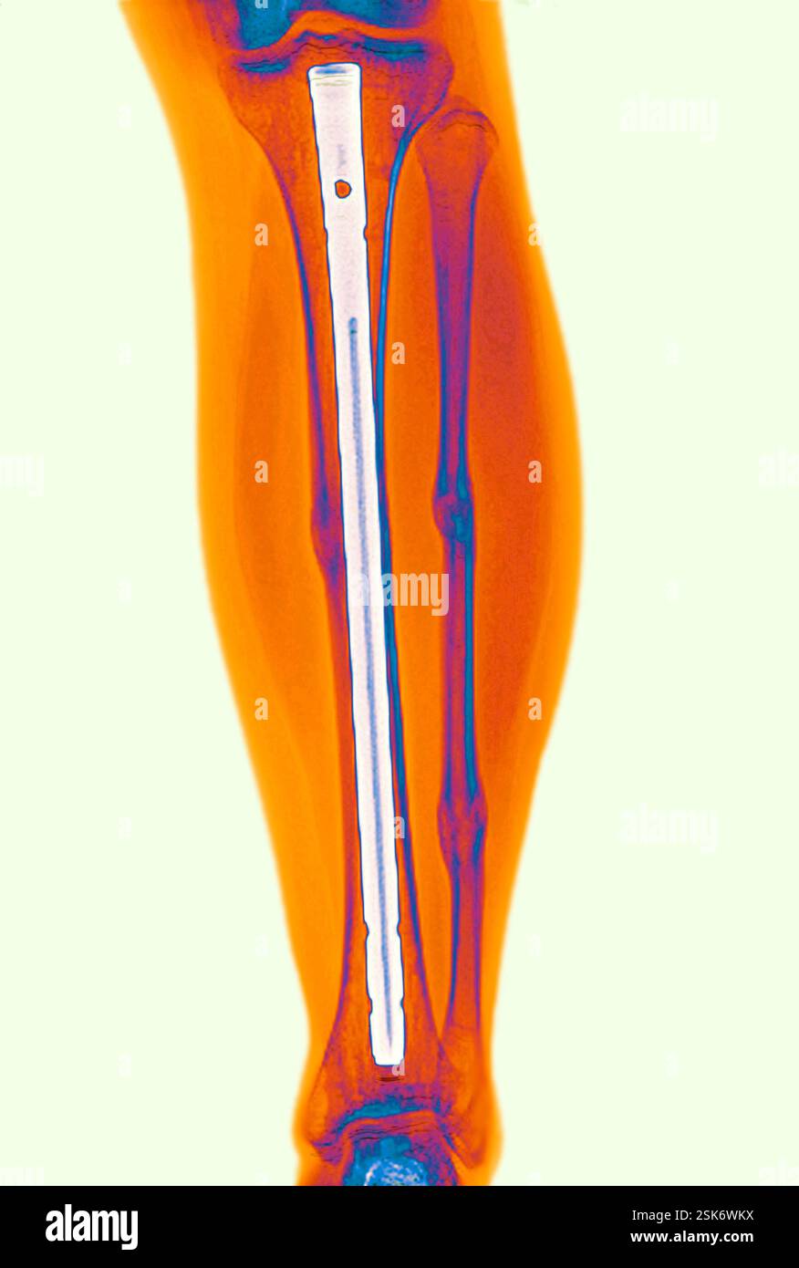 Taux Ipp Fracture Tibia Perone
