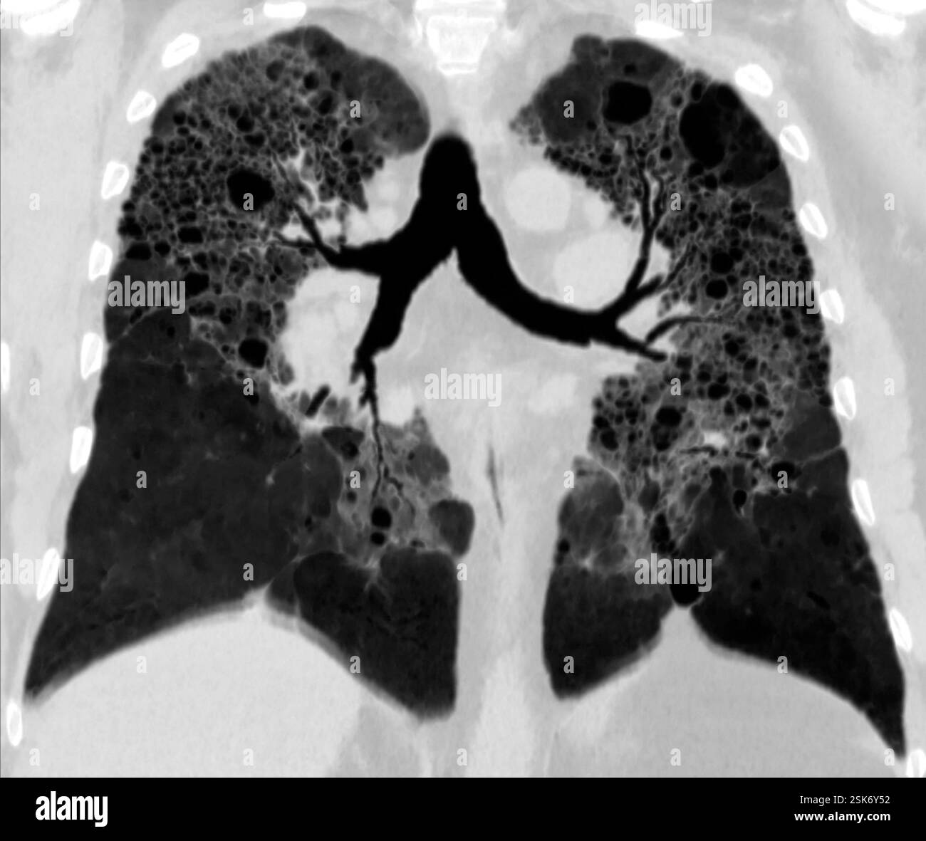 Les poumons dans les pneumopathies d'hypersensibilité ...