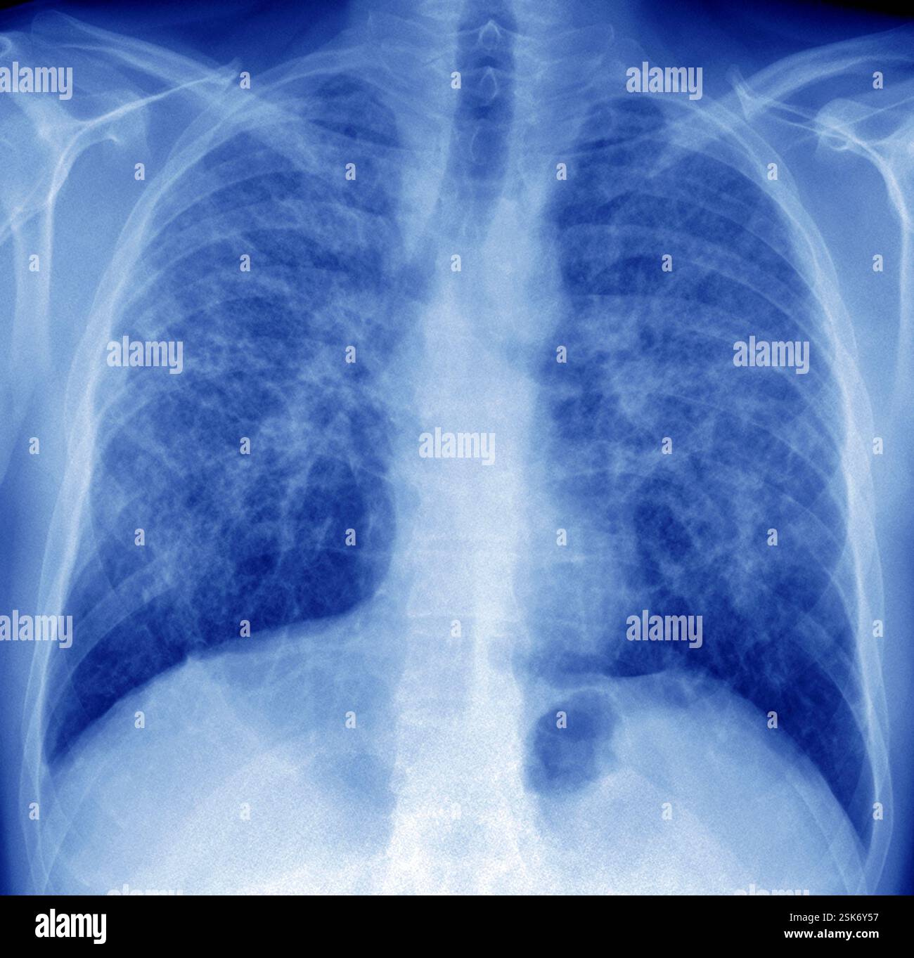Fibrose pulmonaire au cours de la sarcoïdose. Radiographie frontale ...
