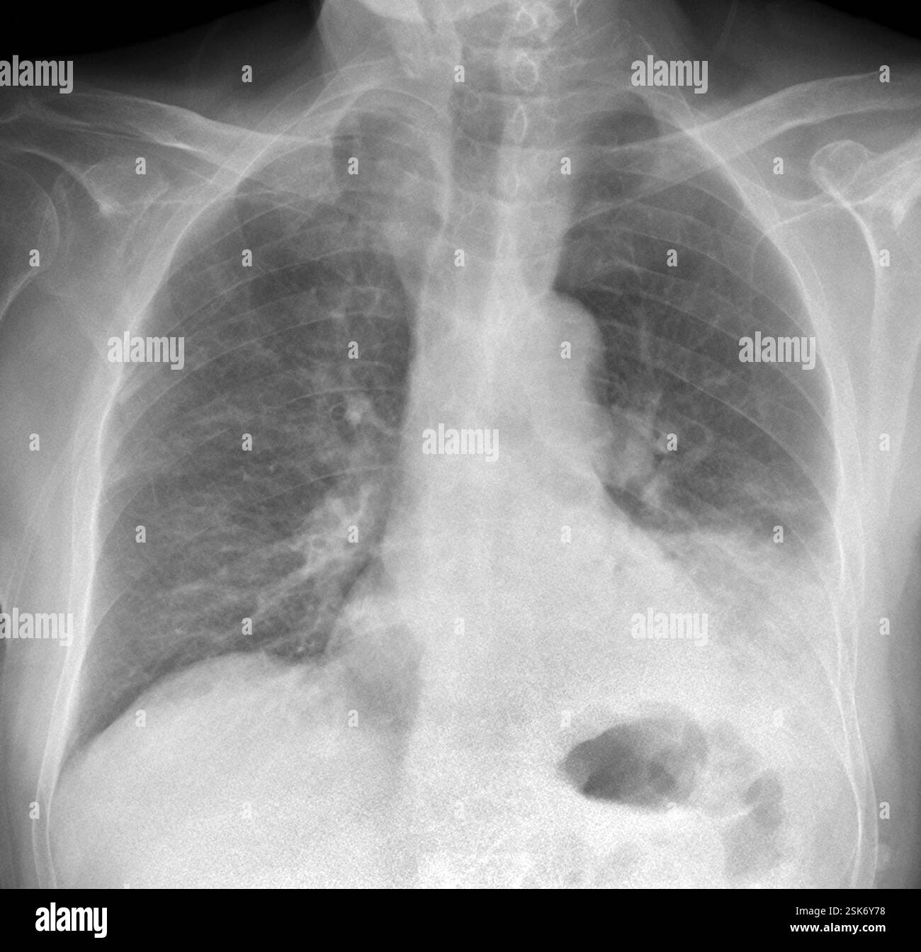 Pneumonie lobaire. Radiographie frontale des poumons d'un homme de 47 ...