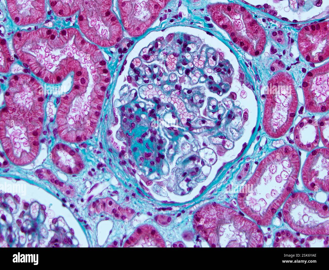 Glomérulonéphrites segmentaires. Micrographie lumineuse d'une coupe d ...