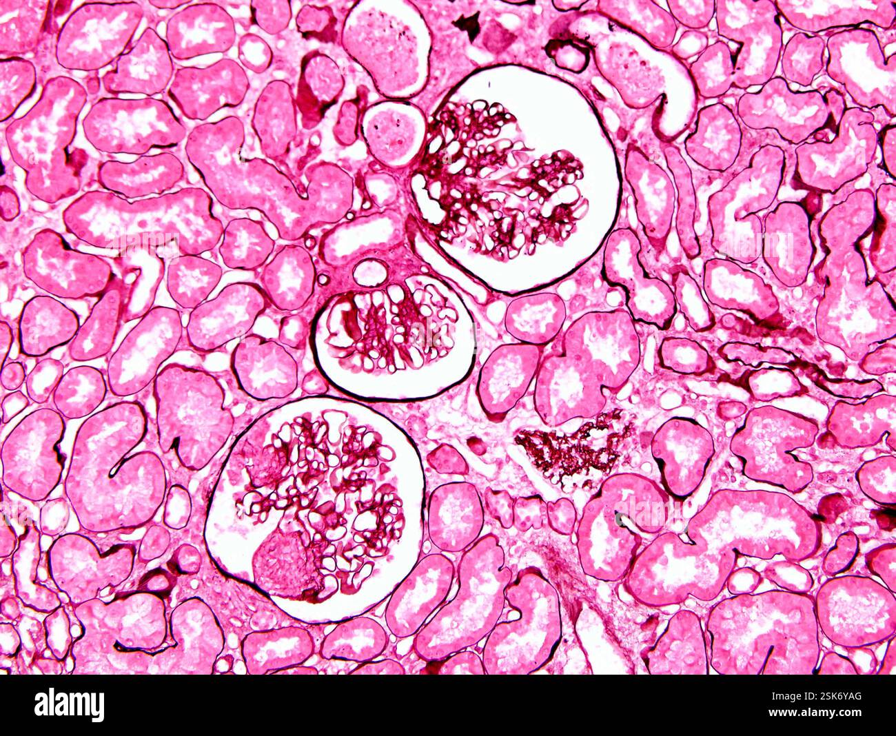 Glomérulonéphrites segmentaires. Micrographie lumineuse d'une coupe de ...