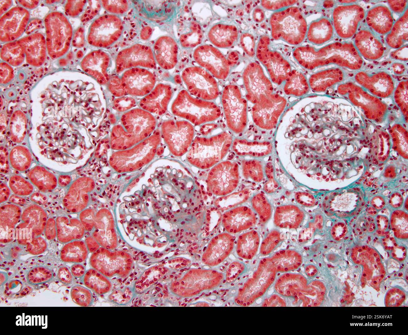 Glomérulonéphrites segmentaires. Micrographie à la lumière d'une coupe ...