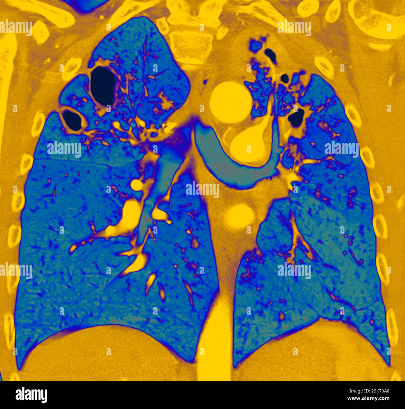 Tuberculose. Tomodensitométrie (TDM) d’un homme de 29 ans atteint de ...