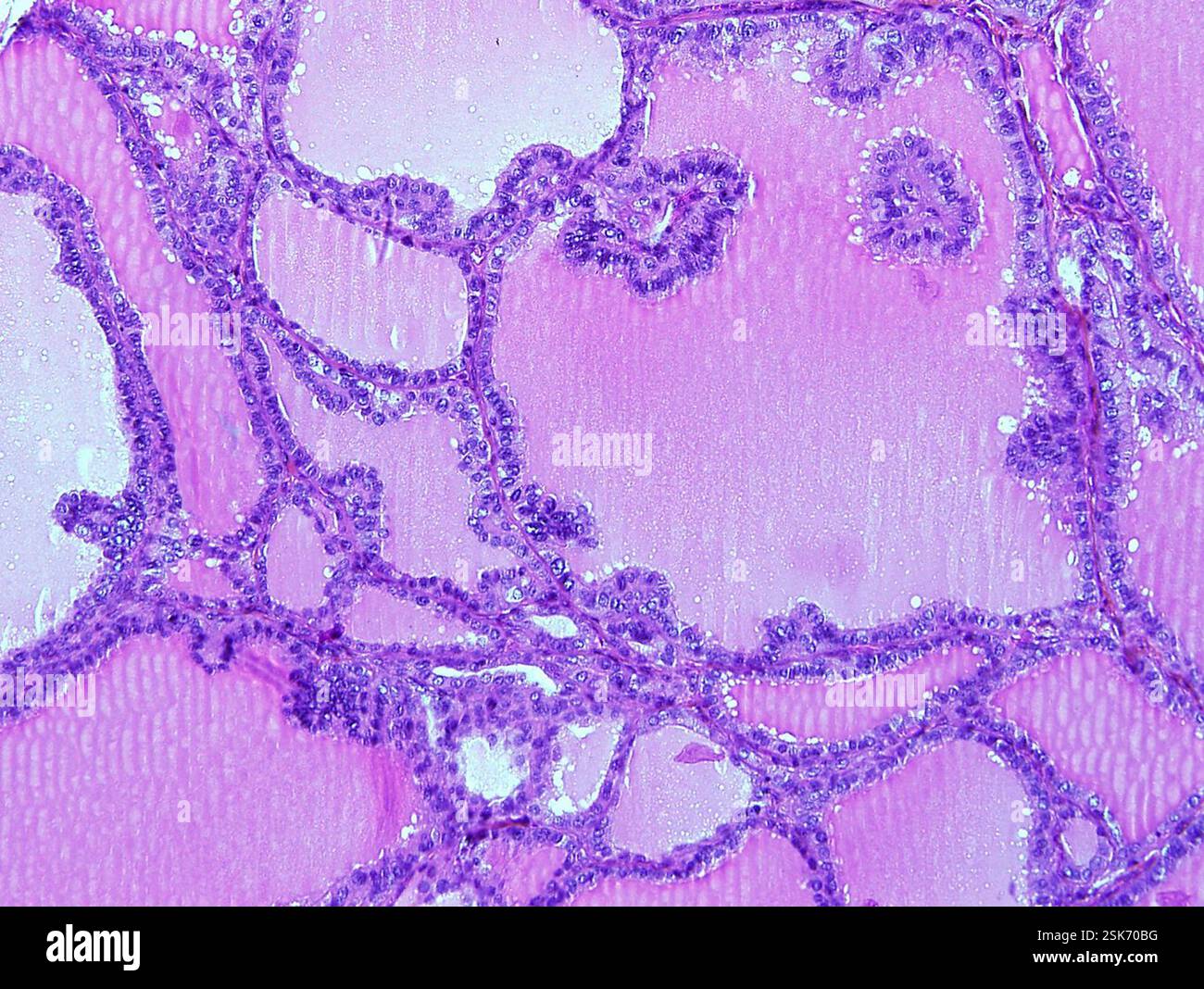 Thyroïde dans la maladie de Basedow. Micrographie à la lumière d'une ...